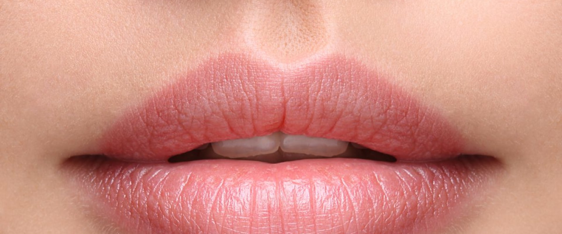 Can Restylane Be Used in Lips? - An Expert's Guide