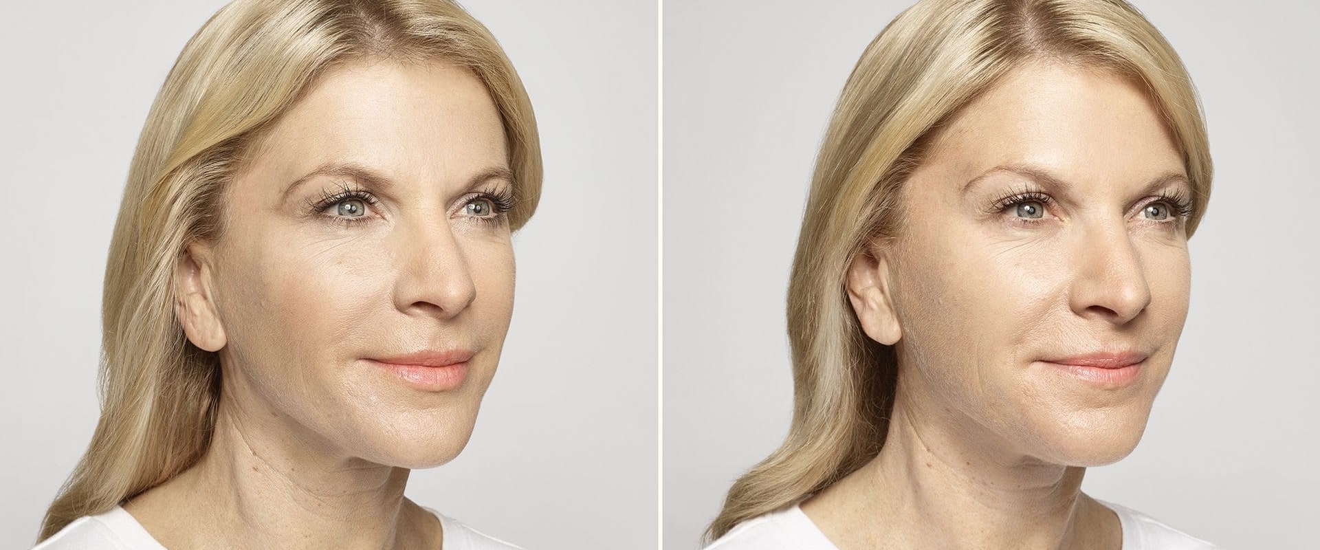 What to Expect After Restylane Treatment